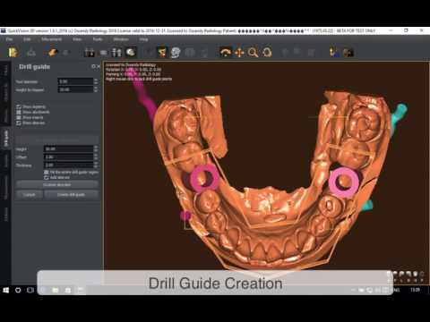 QuickVision 3D - Creating surgical guide - OWANDY RADIOLOGY