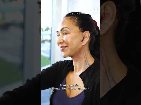 Cecelia's EVE Lift™ Reveal | Eden Plastic Surgery: Dr. Ali Charafeddine, MD