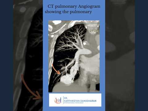 #interventionalradiology treatment of lung arteriovenous malformation
