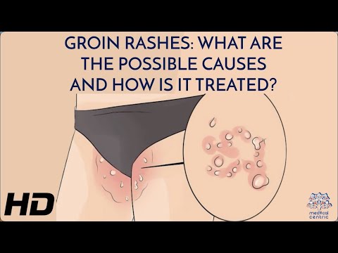 Solving the Mystery of Groin Rashes: What You Need to Know