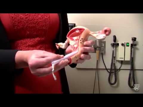 Mayo Clinic Minute: Tampon test for endometrial cancer