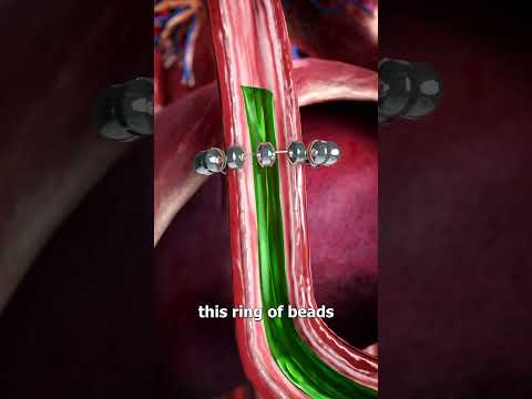 How Beads Stop Acid Reflux 😨