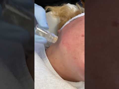 Want Glass Skin? Check out the YPS Gold FillTox Facial! #shorts #botox #microneedling