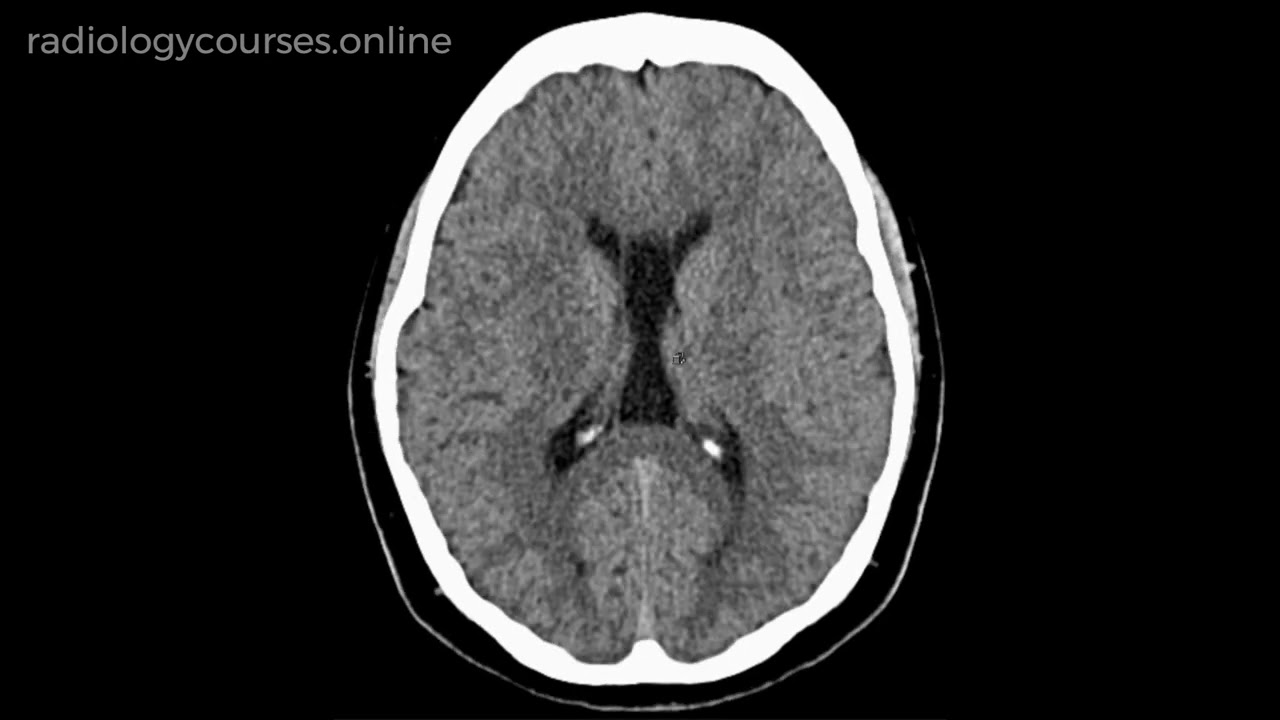 How to differentiate between a persistent cavum septum pellucidum or cavum vergae?
