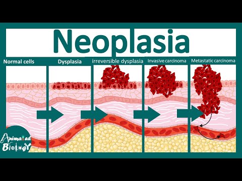 Neoplasia | pathology underlying neoplasia | USMLE