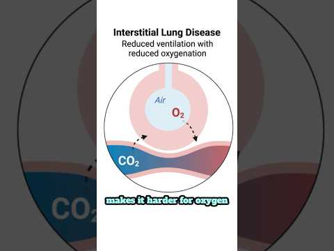 Interstitial Lung Disease (ILD) Explained #interstitiallungdisease #lungs #scienceexplained