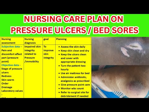 Care Plan on pressure ulcers | nursing care plan on bed sores