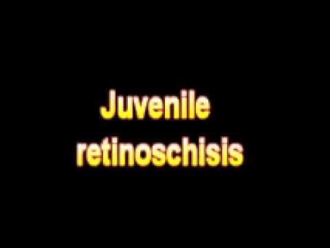 What Is The Definition Of Juvenile retinoschisis - Medical Dictionary Free Online Terms