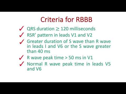 How to identify right bundle branch block (RBBB) in an ECG?