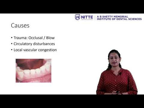 Reversible Pulpitis
