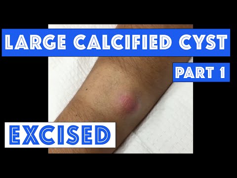 GRAPHIC VIDEO: Huge golf ball-sized cyst pulled from massive lump in ...