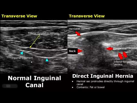 Hernia Ultrasound Normal Vs Abnormal Images | Direct/Indirect Inguinal/Epigastric/Femoral Hernia USG