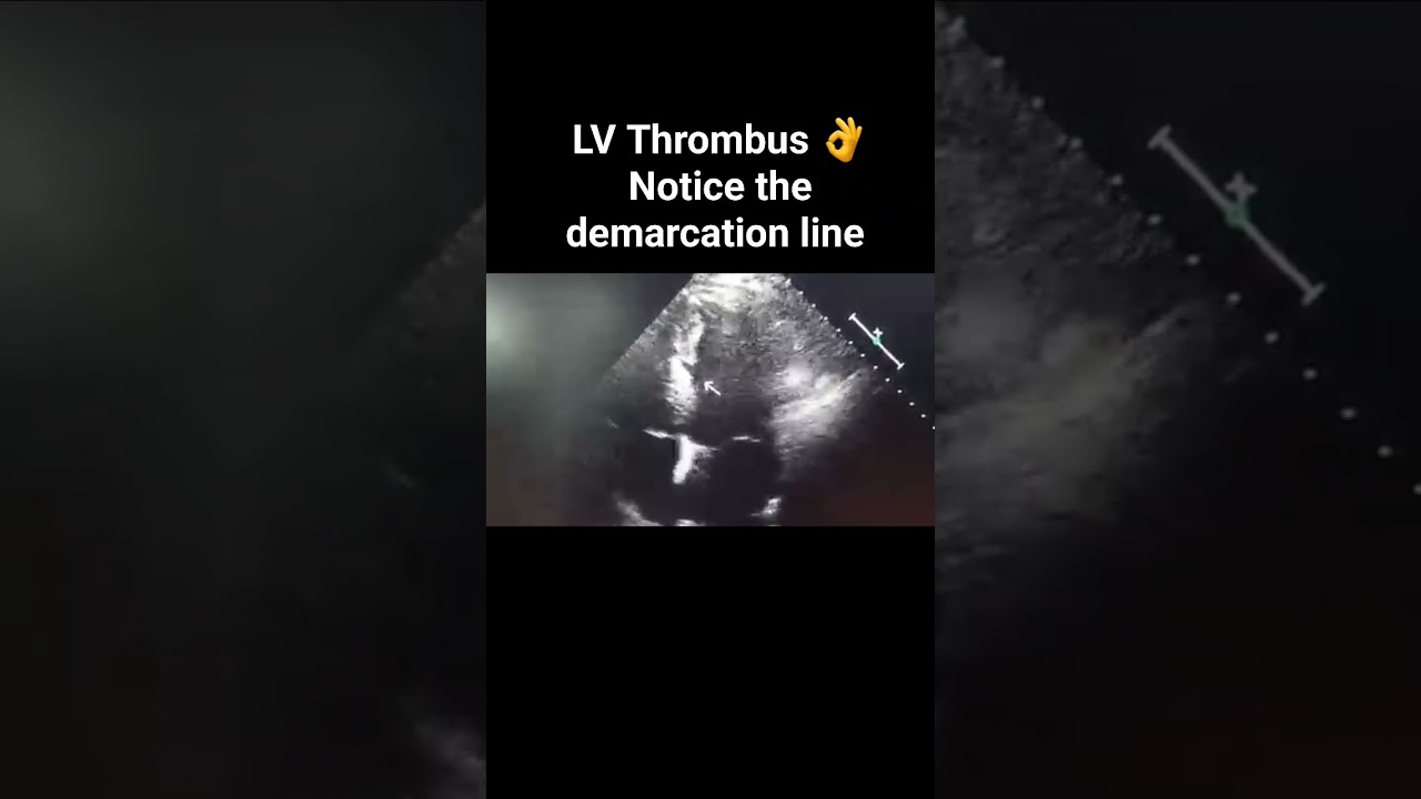 LV thrombus that can be easily missed. The key here  is the line of demarcation (arrow )
