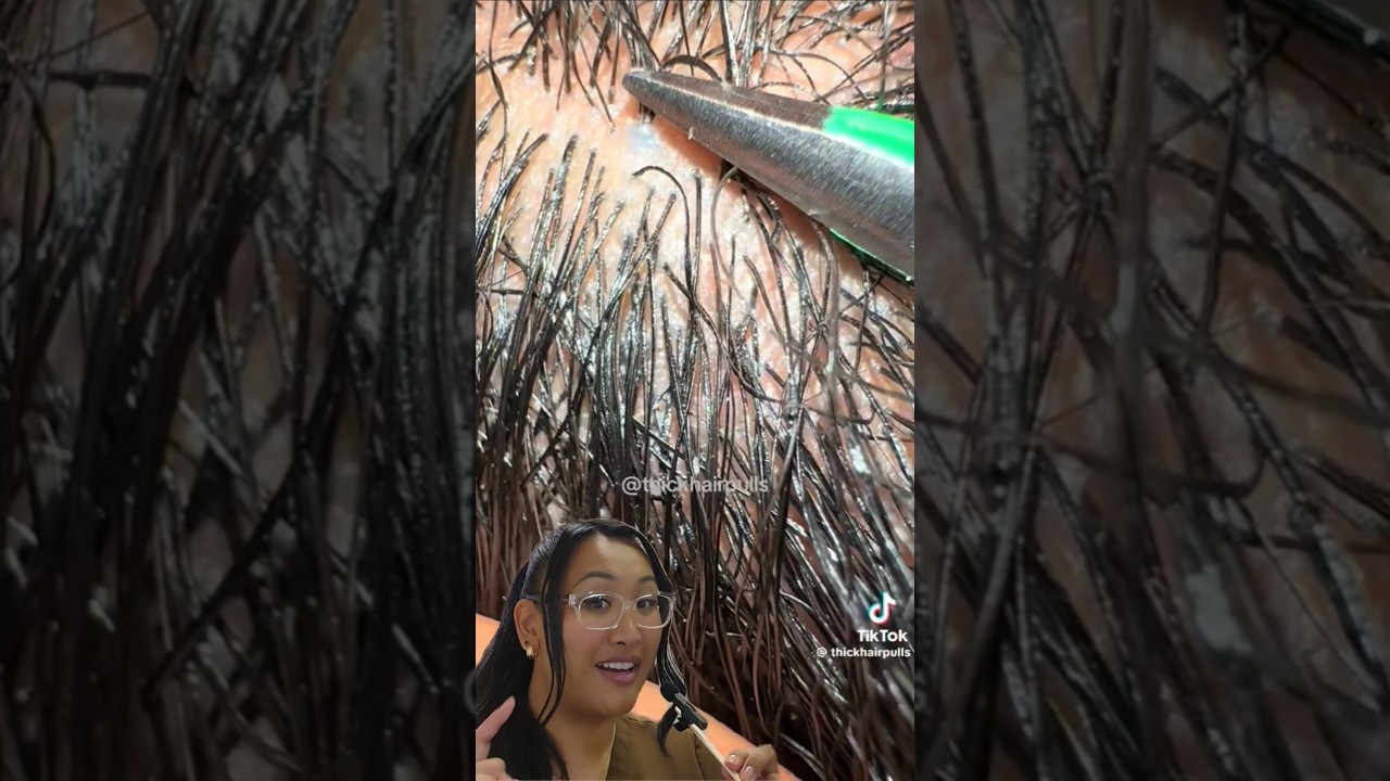 multiple hairs stuck in one pore. #reaction #hairremoval #ingrownhairremoval #wax
