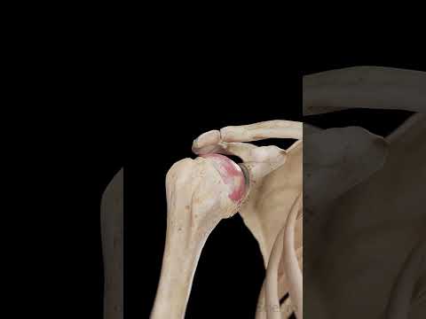 💪 Shoulder Arthritis: Understanding Joint Wear and Tear 💪
