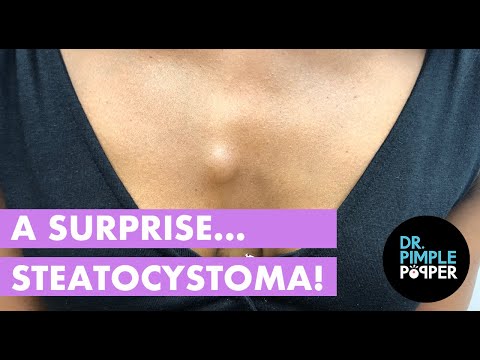 Dr. Pimple Popper Pops Chest Steatocystoma in New YouTube Video