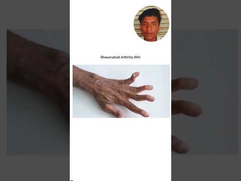Rheumatoid Arthritis (RA) #RxInsights #india #medical #medicalcollege #pharmac