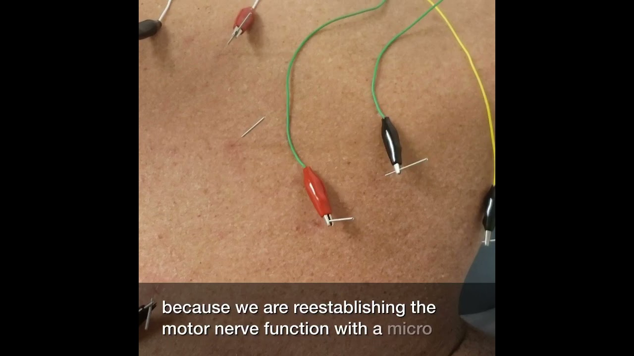 Electro Acupuncture
