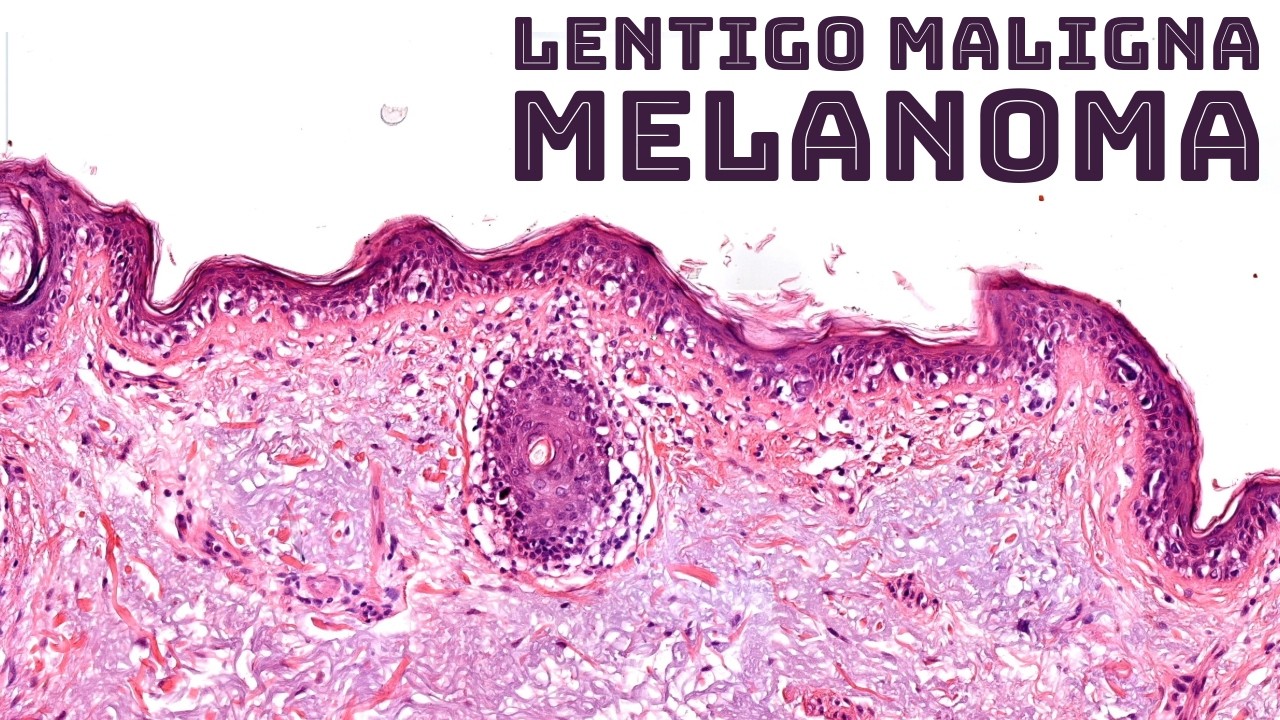 Lentigo maligna melanoma from chronic UV exposure sun damage (pathology dermpath dermatology)