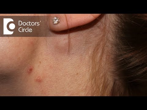 Causes of painful lymph nodes in neck - Dr. Satish Babu K