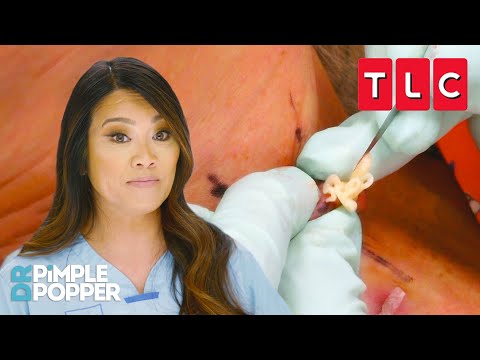 The BEST Pimple Pops | Dr. Pimple Popper | TLC