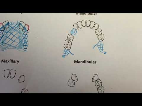 Cast Partial Denture Design Kennedy Class I