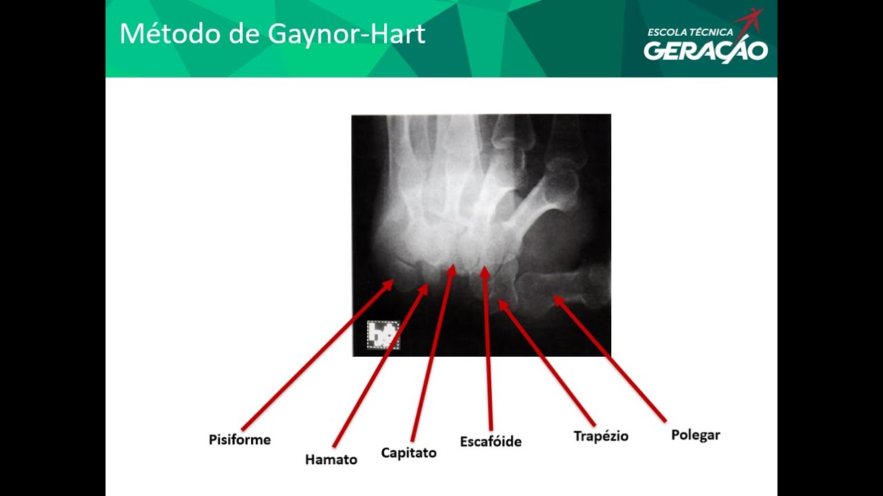 Radiografia do Punho - método de Gaynor Hart (Túnel do Carpo)