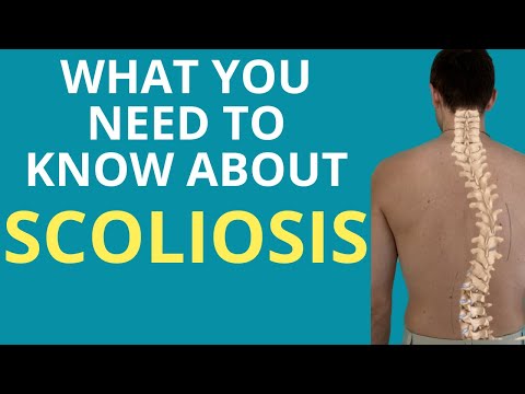 Scoliosis 101: Definition, Symptoms, Treatment, Surgery | Aleks Physio