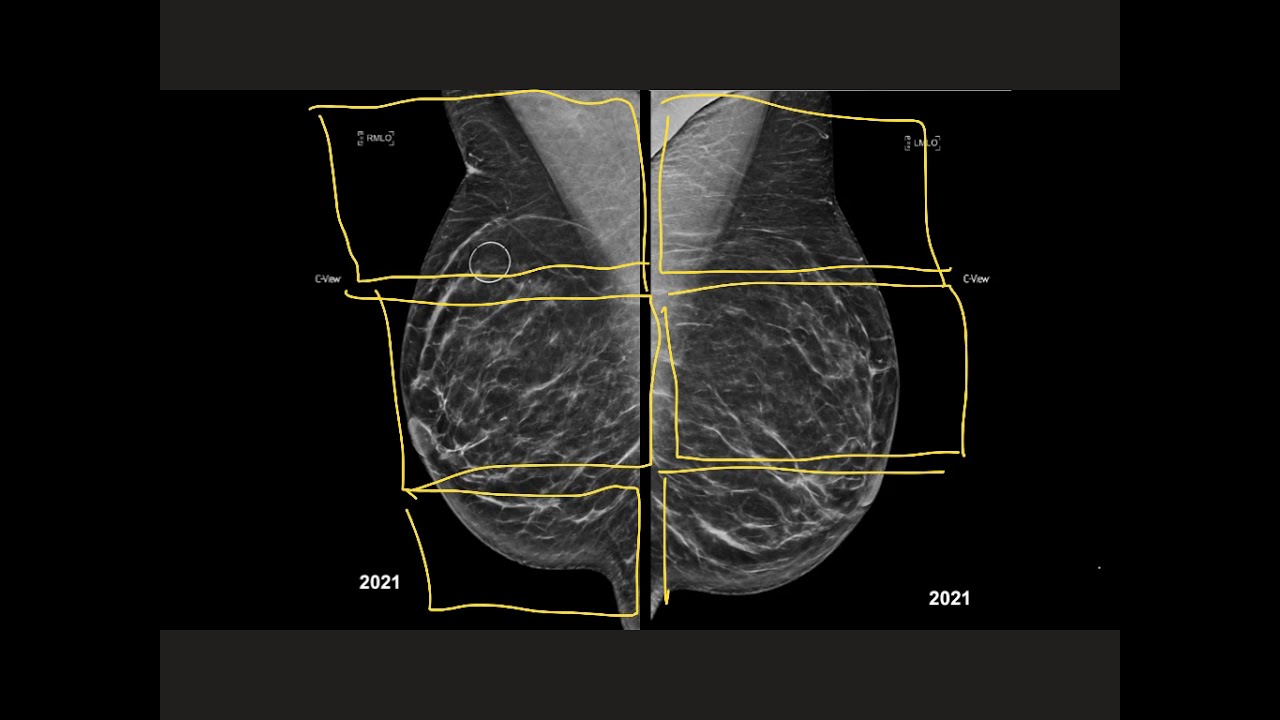 How to read a screening mammogram