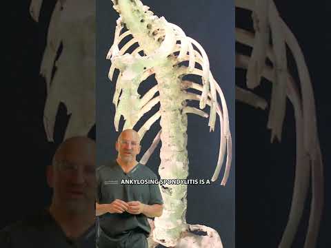 Inflammatory Arthritis That Can Fold the Spine #shorts