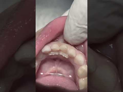Extraction of deciduous teeth #dentist