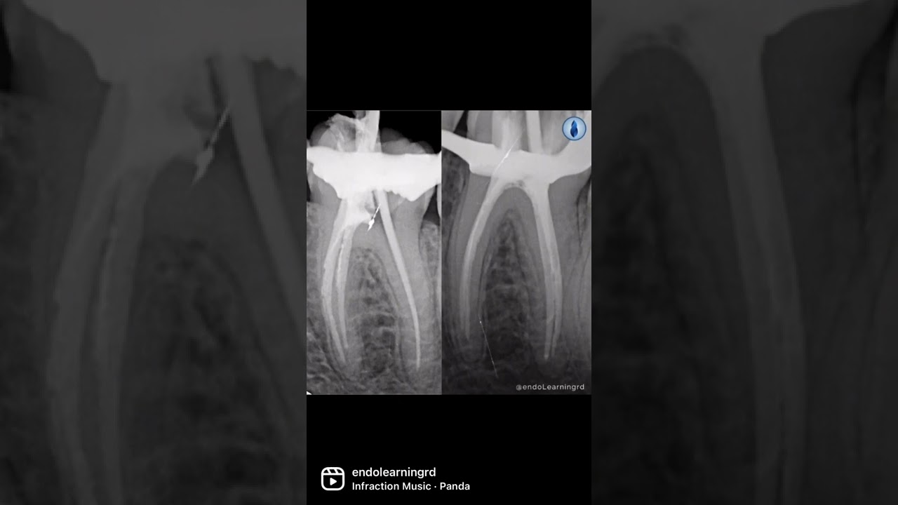 Molar inferior
