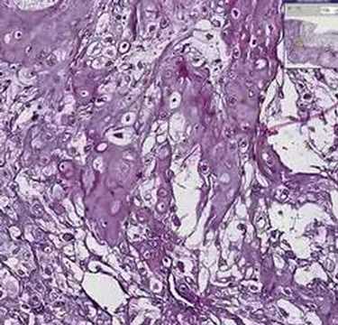 Histopathology Bone--Chondroma
