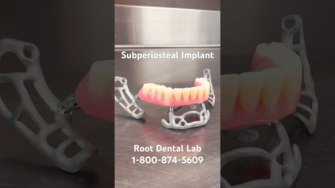 Subperiosteal Implant! #dentist #dentalrestoration #oralsurgery #implant #usamade #dentallab #teeth
