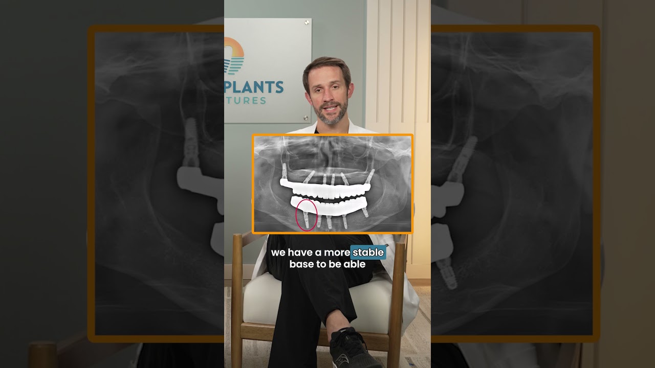 Are You Eligible for Dental Implants?