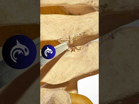 See how a Posterior Cervical Foraminotomy of the Spine works #3D #backpain #spine