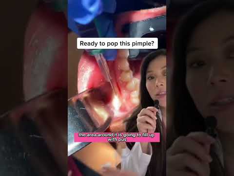 Huge puss filled tooth infection! #infection #dentist #pimplepopper