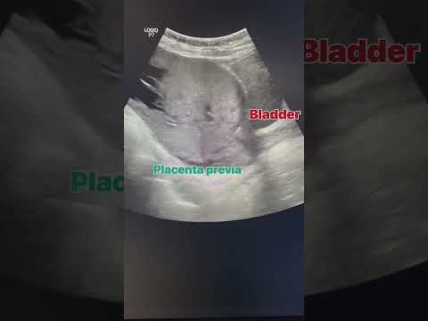 Placenta previa ultrasound #placentia #ultrasound #radiology #sonography #ultrasonography
