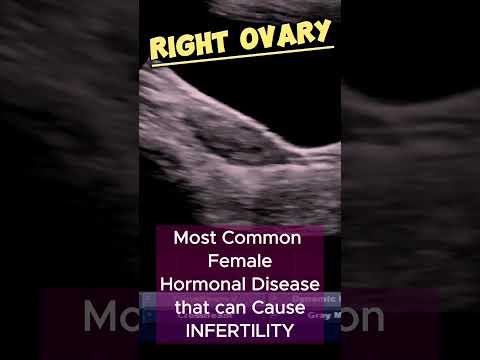 PCOS - Polycystic Ovaries | PCO - TVS Ultrasound