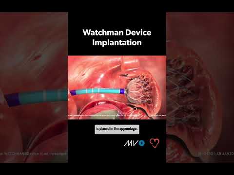 Watchman Implant Procedure 🫀 for #afib related #stroke