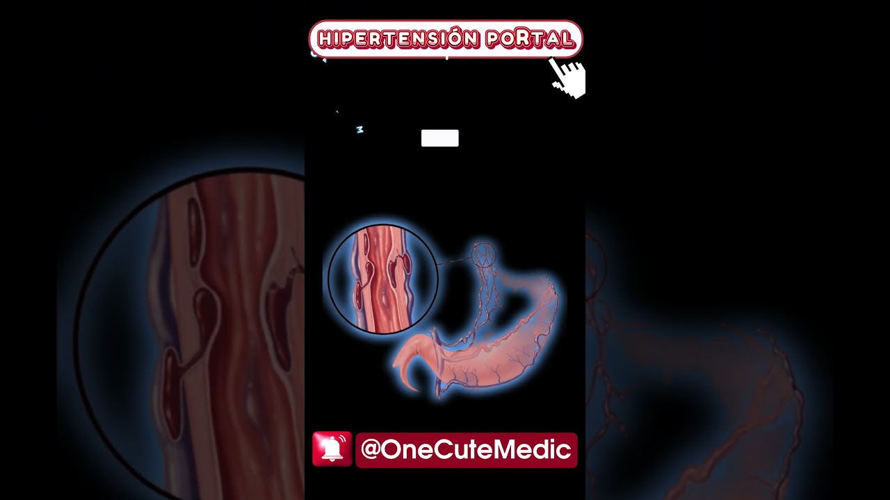 HIPERTENSIÓN PORTAL - @OneCuteMedic