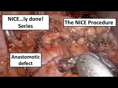 NICE…ly done! How To Repair A Defect At The Anastomosis During The NICE Procedure