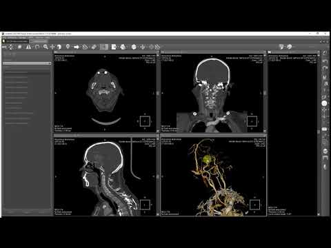 Carotide vessels analysis with dual scan bone removal