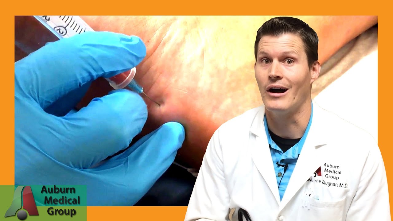 Plantar Fasciitis Injection Treatment for  Heel Pain | Auburn Medical Group
