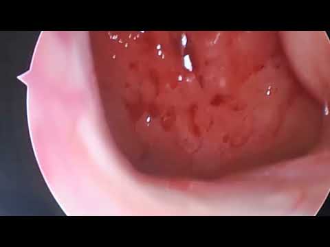 AC polyps sinuses @drsmdsms