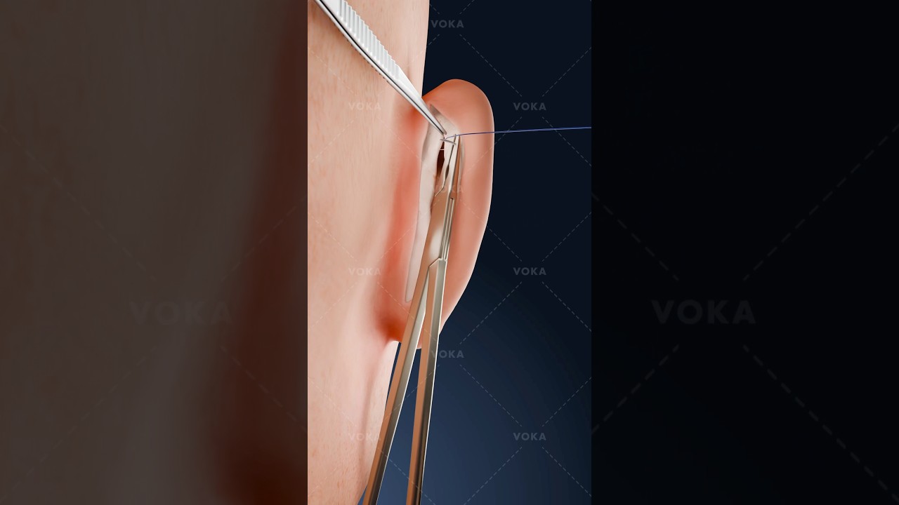 How are protruding ears corrected through surgery? VOKA 3D visualization