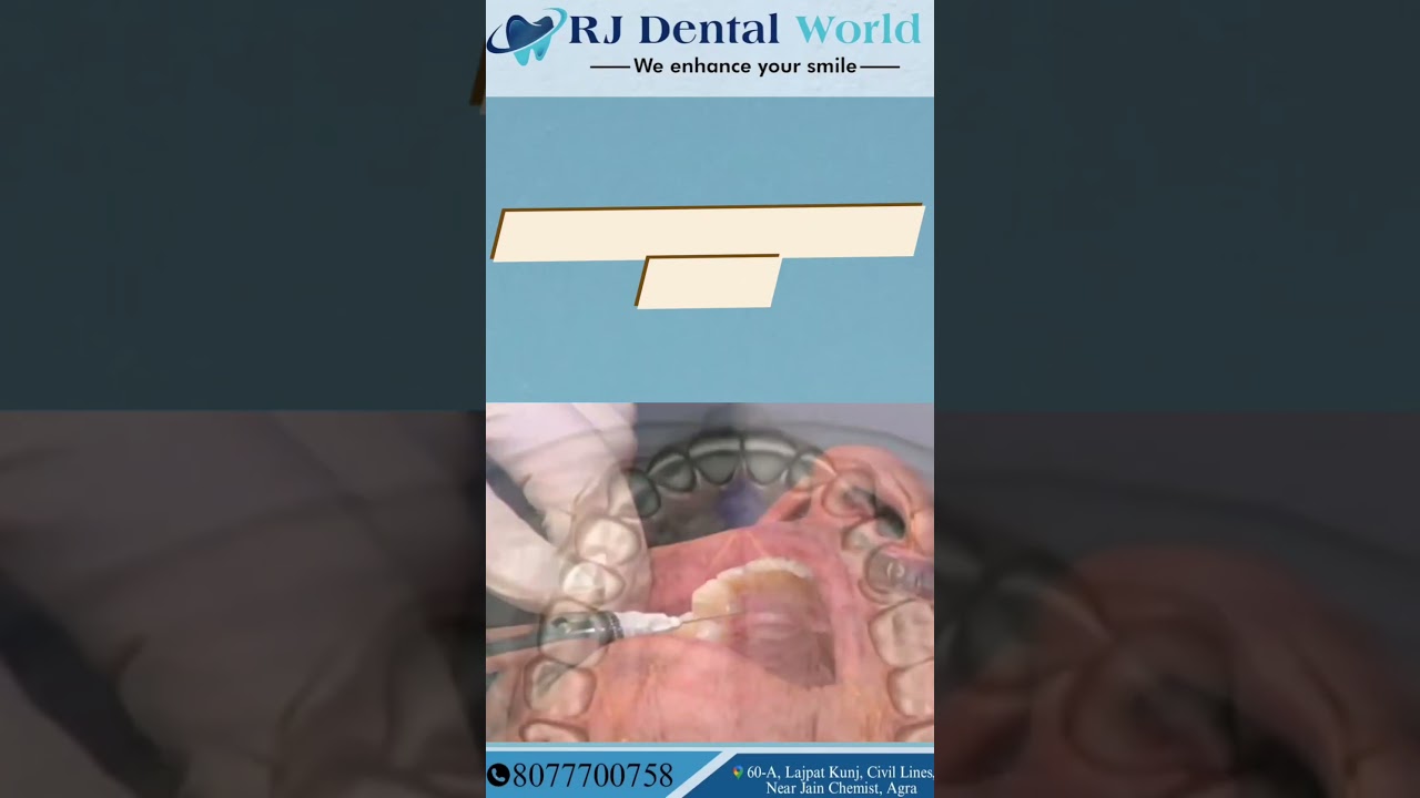 Nasopalatine Nerve Block | MAXILLARY ANTERIO PALATAL ANESTHESIA
