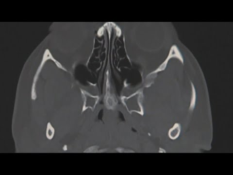 CTE study out of Boston University could be a game changer