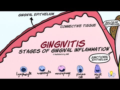 Gingivitis: Stages of Gingival Inflammation