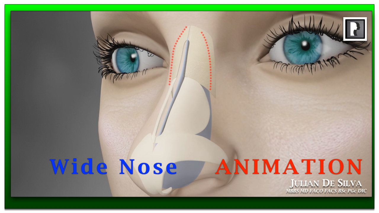 Rhinoplasty Animation - How can a Wide nose be narrowed?